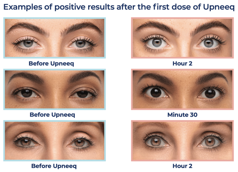 Upneeq® - Live Oak Med Spa